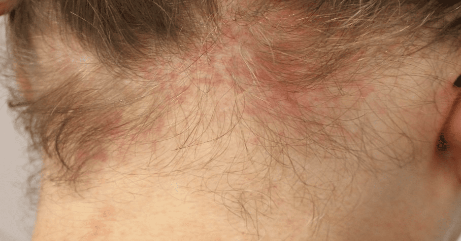 WHAT IS ALOPECIA AREATA